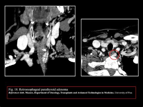 Figure 1 From Imaging Findings Of Parathyroid Lesions In Primary Hyperparathyroidism Semantic