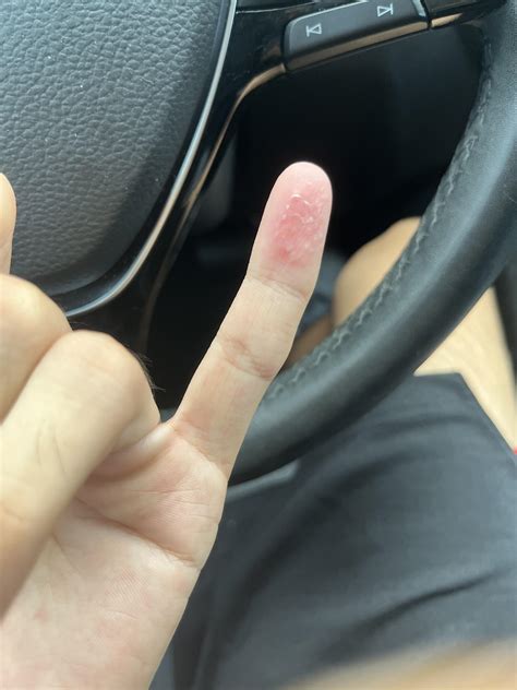 Weird Bump On Finger Rdermatophagia