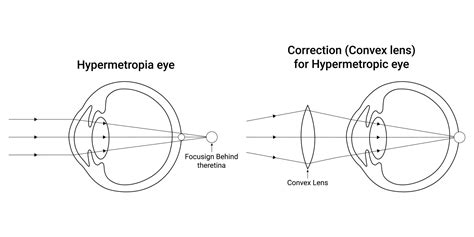Hypermetropia Eye Science Design Vector Illustration Diagram 35945075 Vector Art At Vecteezy