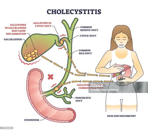 Cholecystitis As Gallbladder Inflammation From Gallbladder Outline