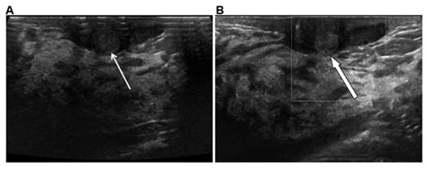 Diagnostic Evaluations Of Ultrasound And Magnetic Resonance Imaging In