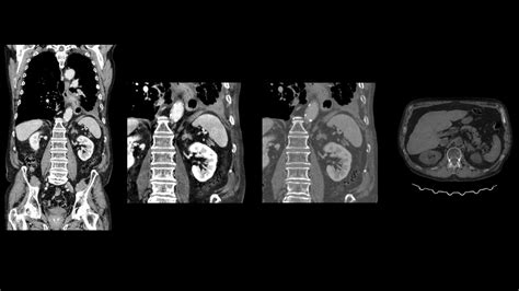 Dual Energy Ct Spectral Imaging Siemens Healthineers Usa