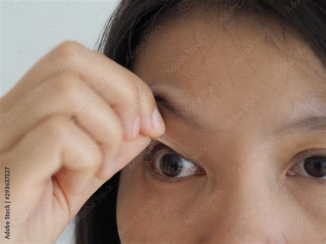 Exophthalmos Or Bulging Eyes In Woman Have Eyeball Protrudes From The