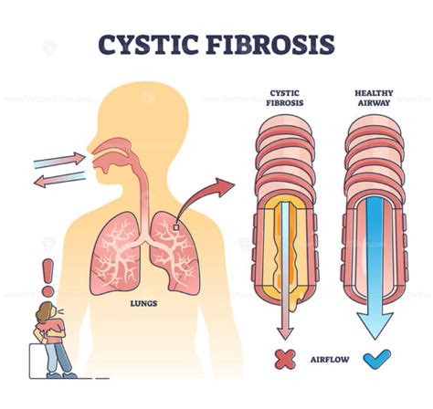 Incontinence Problem With Stress Owerflow And Urge Types Outline