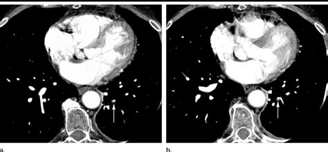 Transverse Contrast Enhanced Ct Angiograms Of Isolated Subsegmental Pe Download Scientific