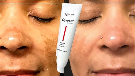 Cysteamine Cream Hyperpigmentation Treatment Online Retailer