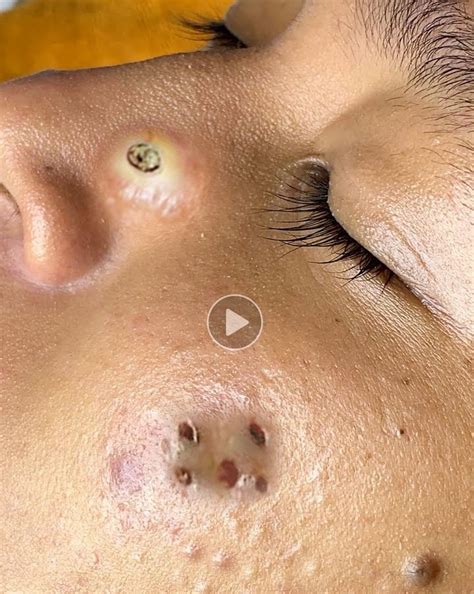 Pimple 😱 You Wont Believe What Came Out Of This One 📌 Full Clip