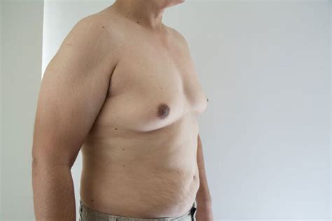 What Is The Difference Between Gynecomastia And Pseudogynecomastia