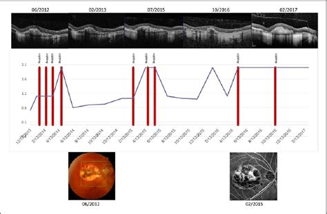 Figure 2 From Long Term Results Of Intravitreal Bevacizumab And Dexamethasone For The Treatment