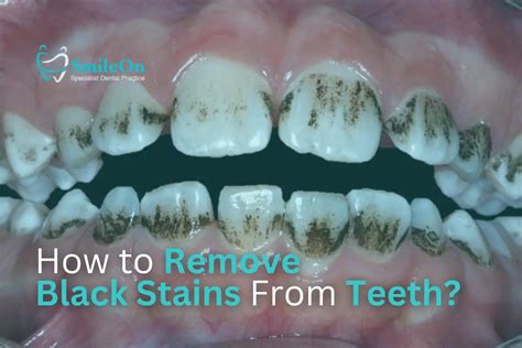 How To Remove Black Stains From Teeth Smileonpk