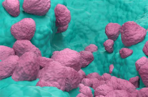 Non Small Cell Lung Cancer Nsclc In The Lung Tissue â€“ Closeup View 3d Illustration Stock