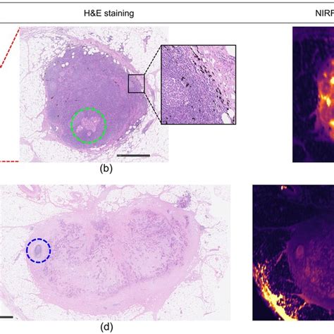 Massive Lymph Node Metastases In A Sln A Ex Vivo Macroscopic View With