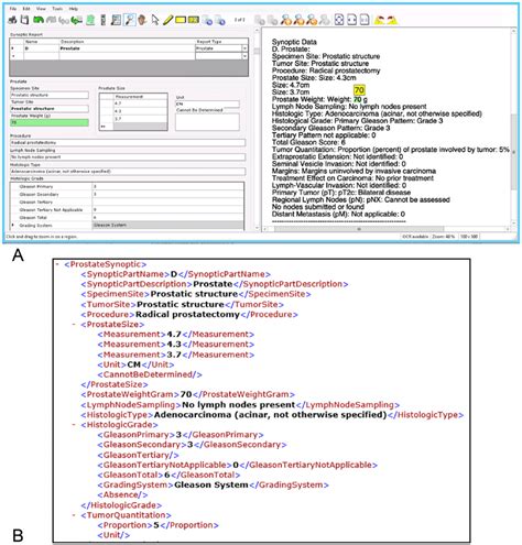 An Example Of Pathology Report Data Extraction Using Extract Systems