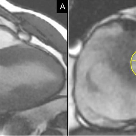 Measurements In The 3ch And Sax Views A The Linear Dimension Of The Download Scientific