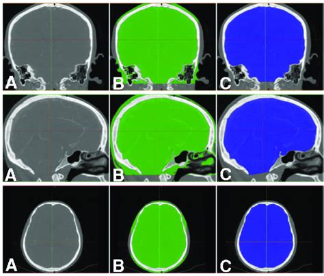 Process Of Three Dimensional Reconstruction For Cranial Capacity A
