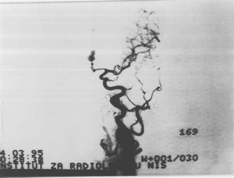 A And Bthe Right And Left Carotid Artery Angiography Revealed An