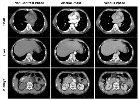Vindr Multiphase A Benchmark Dataset For Phase Recognition In Abdominal Contrast Enhanced Ct