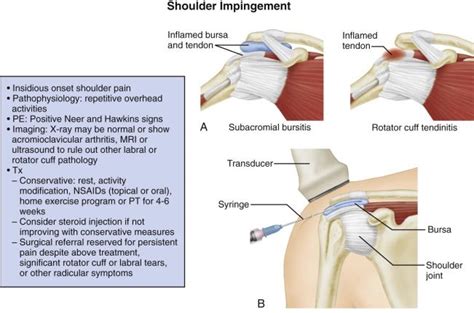 📌subacromial Impingement Occurs In The Subacromial Space Between The… Abdalrahman Attia