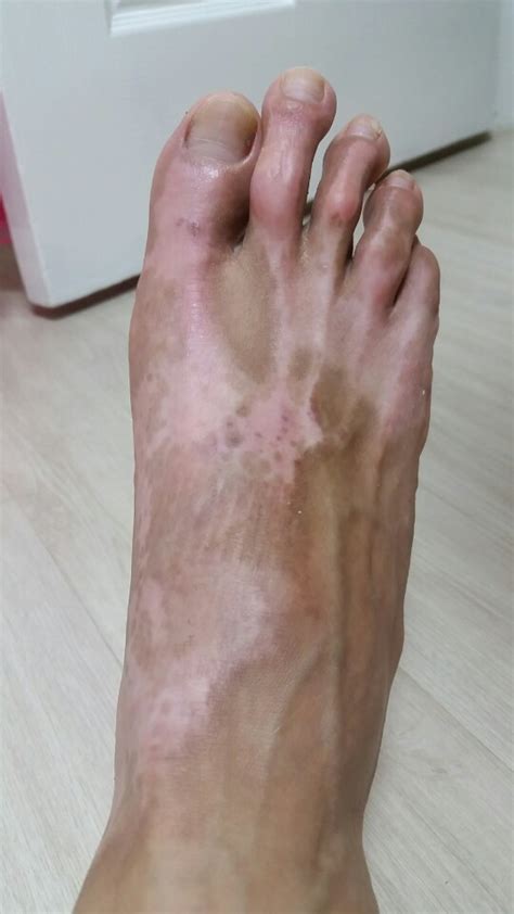 무지외반증교정기 6개월째 사용 중인 후기 효과 보고 있어요 네이버 블로그