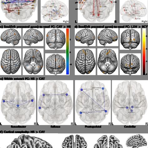 Altered Resting State Functional Connectivity And Cortical Complexity Download Scientific