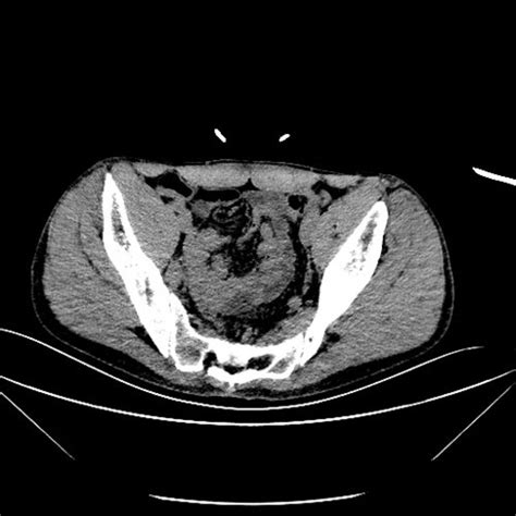 Pelvis Abdomen And Pelvis Cts