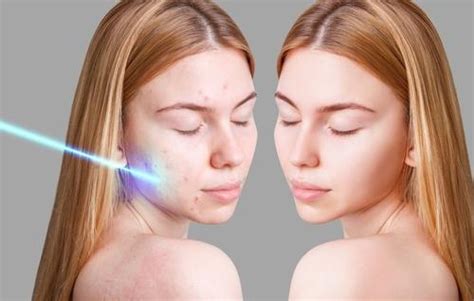 Laser Resurfacing For Acne Scars Treatment Options And Expected Results