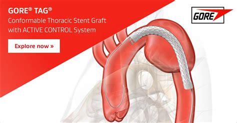 Sam Riffle On Linkedin Gore® Tag® Conformable Device Time Tested