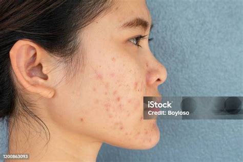 그녀의 뺨에 여드름 염증 의 문제가있는 여성의 반 얼굴의 측면보기 여드름에 대한 스톡 사진 및 기타 이미지 여드름 흉터 뾰루지 Istock