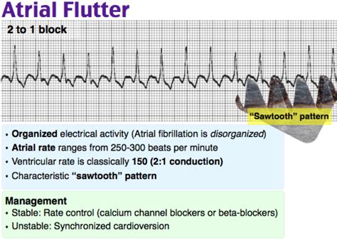 EmDOCs Net Emergency Medicine EducationEM 3AM Atrial Flutter