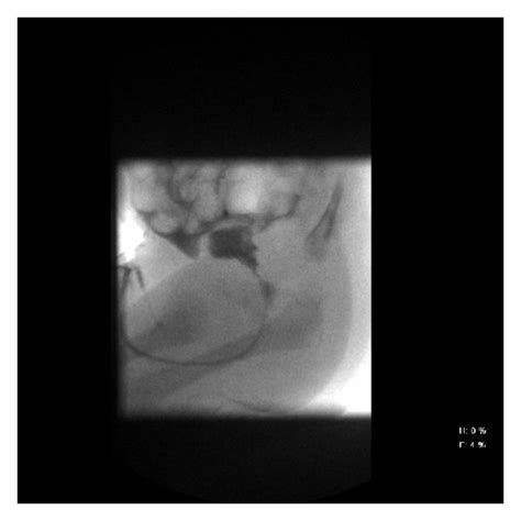 Water Soluble Contrast Administered Via Indwelling Transurethral Download Scientific Diagram