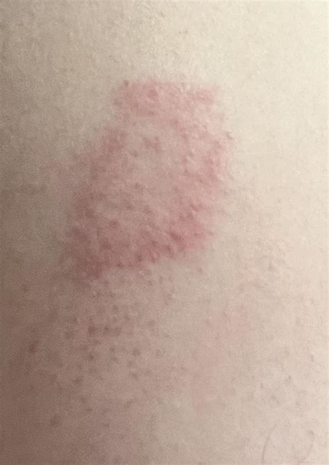 Bee Sting Question Rbees