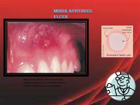Aphthous Ulcer