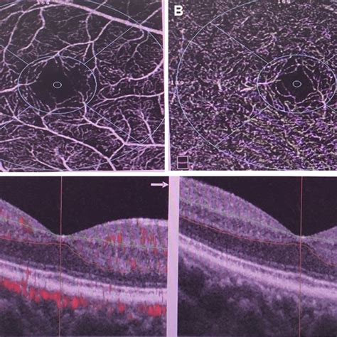 OCTA Of Normal Eye A Vascular Image Of SCP B Vascular Image Of DCP C Download Scientific