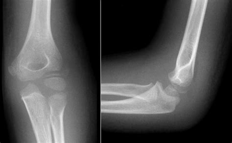 Supracondylar Fracture Pediatric Pediatrics Orthobullets My Xxx Hot Girl