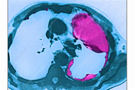 Lung Cancer Caused By Asbestosis Ct Scan Stock Image C0389024
