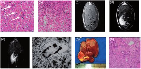 Hepatocyte Coagulation Necrosis Induced By Combined Portal Vein And Download Scientific