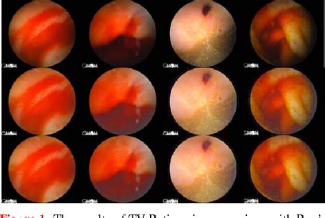 Figure 1 From Detection Of Bleeding Patterns In Wce Video Using Tv