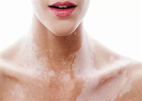Does Leucoderma Spread From One Person To Another