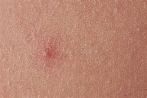 Red Pimple On Human Skin Stock Photo Image Of Facial