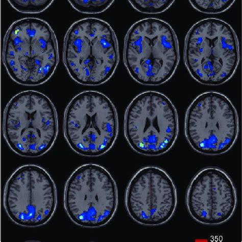 Brain Regions Most Informative For Classification Shaded Regions Download Scientific Diagram