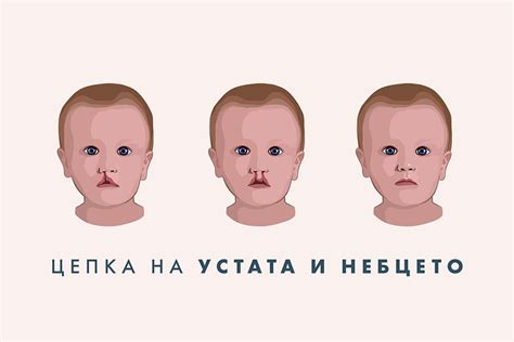 Цепната устна и цепнато небце при новородени For Life