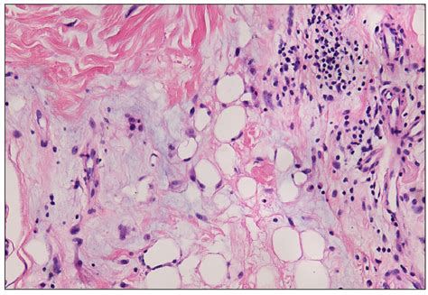 Linear And Annular Lupus Panniculitis Of The Scalp Indian Journal Of Dermatology Venereology