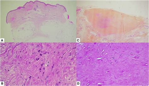 Diagnosis Of Whipples Disease With Pseudorheumatoid Nodules In A Patient Treated With Biologics