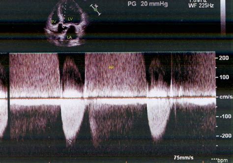 Aliasing And Nyquist Limit In Doppler Echocardiography All About