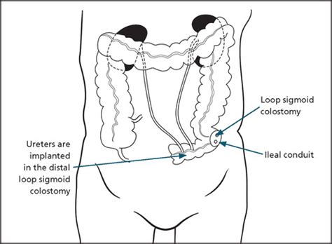 Double Barrel Ileostomy