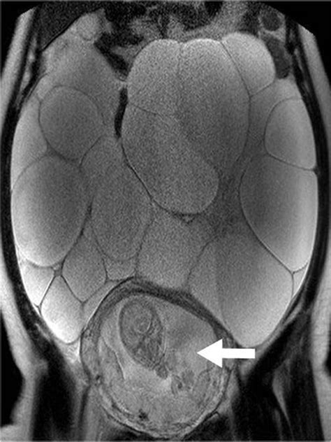Mri Features Of Ovarian Cystic Lesions Park 2014 Journal Of