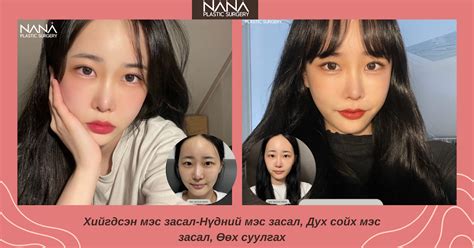 Мэс заслын дараах өөрчлөлт [НАНА ГОО САЙХНЫ ЭМНЭЛЭГ]👩‍⚕️🏥🥰