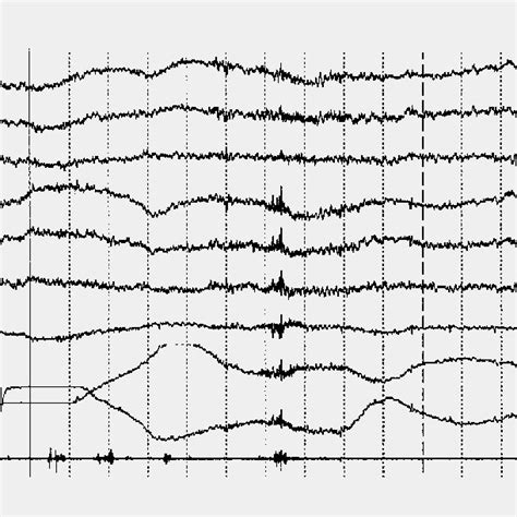 Continuous Muscle Interference At Electrode A1 And Slow Eye Movement Download Scientific
