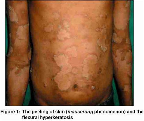Ichthyosis Bullosa Of Siemens Response To Topical Tazarotene Indian