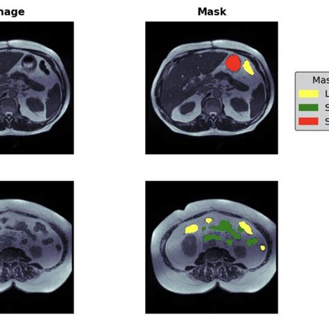 dataset scans with masks of organs overlapped onto the scan